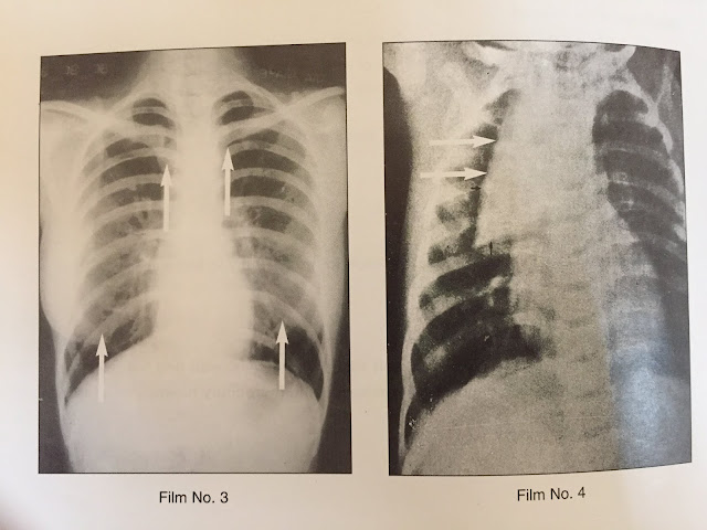 NORMAL VARIANT OF CHEST XRAY