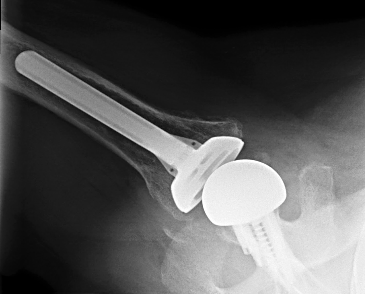 UW Shoulder and Elbow Academy: Reverse total shoulder - choosing a ...