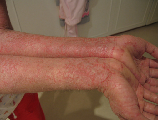 Why This Heat is Causing Us Skin Problems