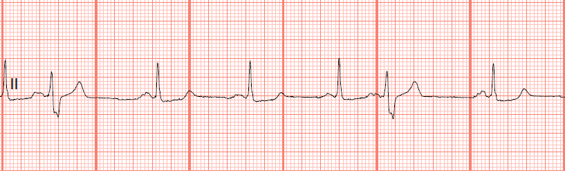 Basic EKG Rhythm Test 45