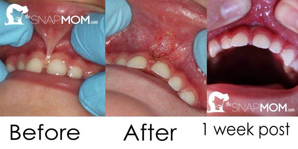Dentist East Berlin PA: Lip-Tie Images: Pre & Post Lip-Tie Treatment