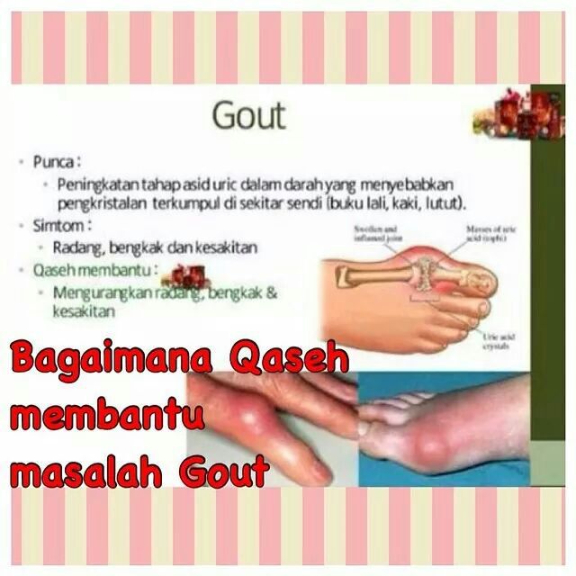 QASEH KARTINI: PUNCA GOUT DAN CARA MENGATASINYA