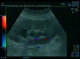 ecografie imagini medicina renal Renal nativ Hidronefroza | Terapii ...
