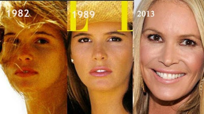 Elle Macpherson Plastic Surgery Before and After Botox and Breast ...