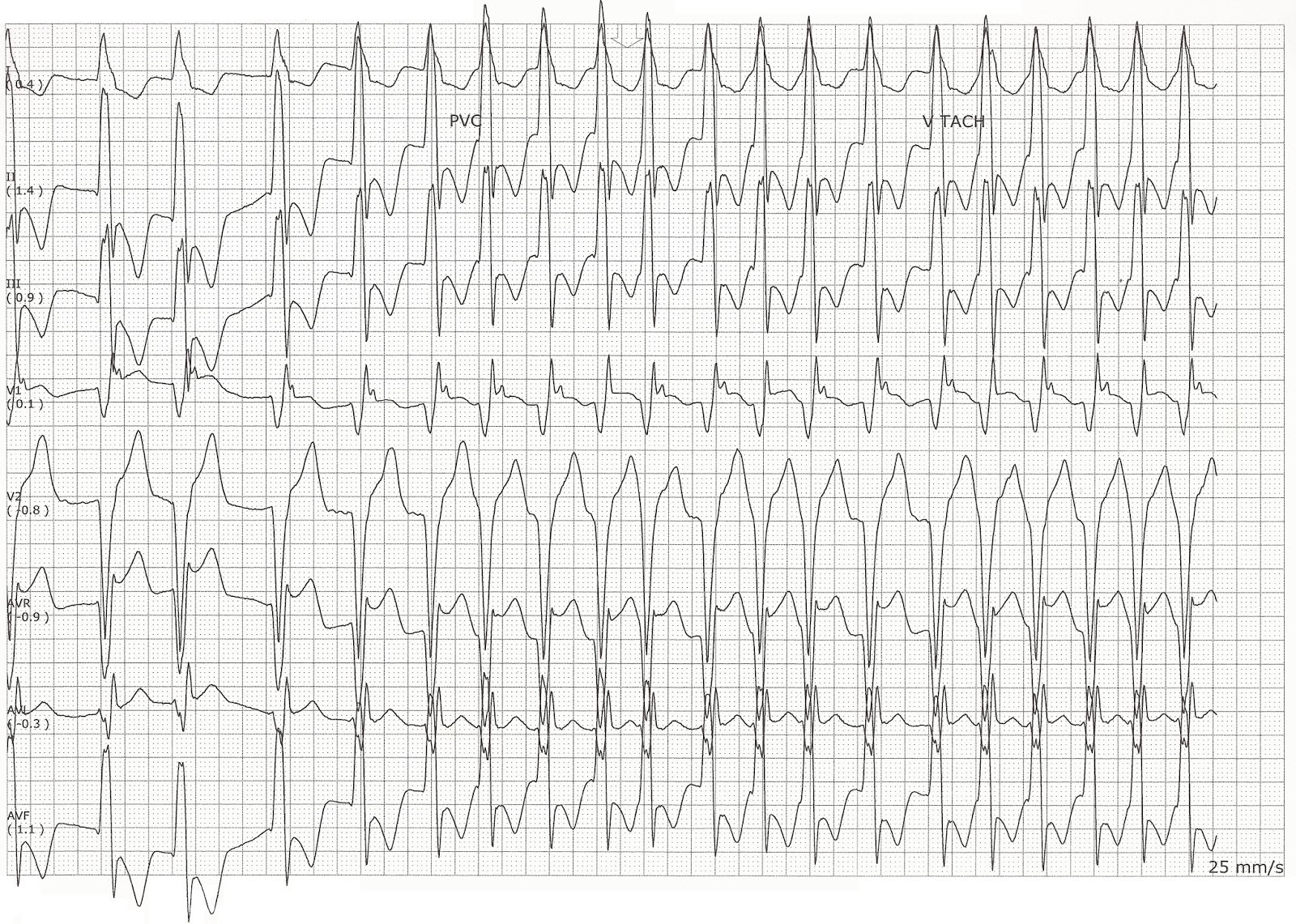 Run of Ventricular tachycardia