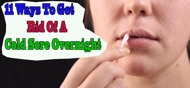 1 Ways To Get Rid Of A Cold Sore Overnight | Tips Mag