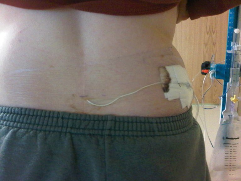 Lesli's Health Blog: Hospital stay- spinal catheter gone wrong ...