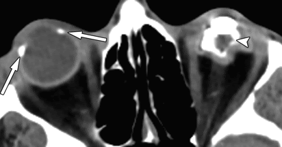 Radiology Medical Imaging Articles: Orbital Calcifications radiology ...