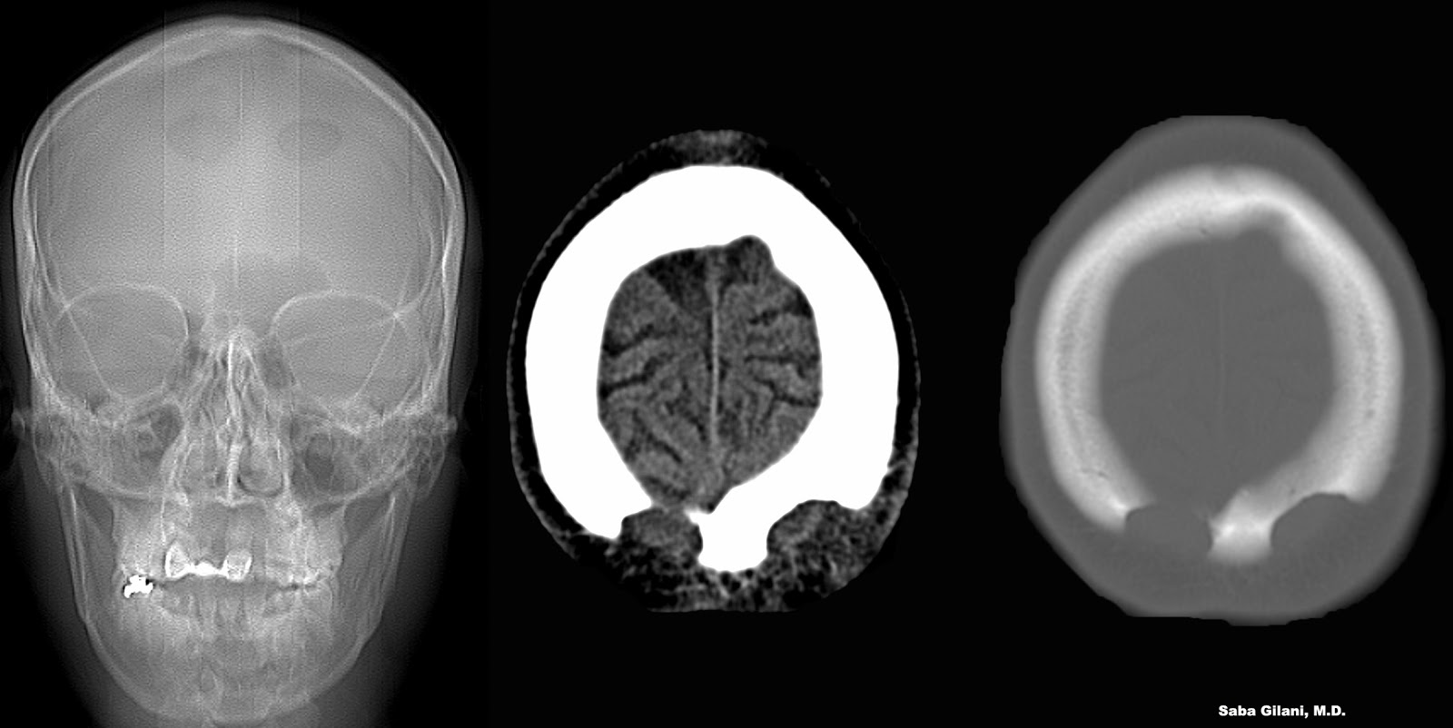 Roentgen Ray Reader: Enlarged Parietal Foramina