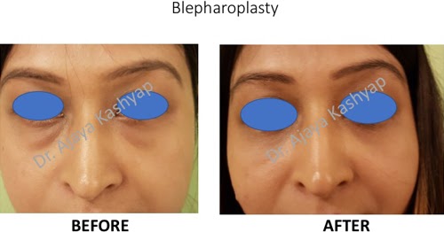 Myths and Facts about Blepharoplasty Surgery
