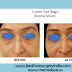 Eye Lift: Blepharoplasty (Eyelid Surgery) Information