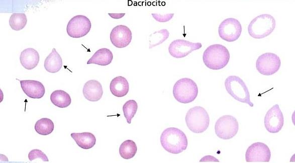 FICHERO DE HEMATOLOGIA: DACRIOCITOS