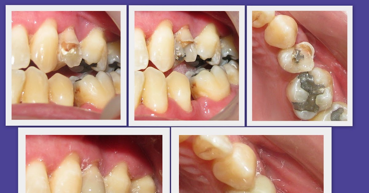 Una raiz o diente fracturado ¿Se puede salvar? | Odontologia Salud y Hoy!