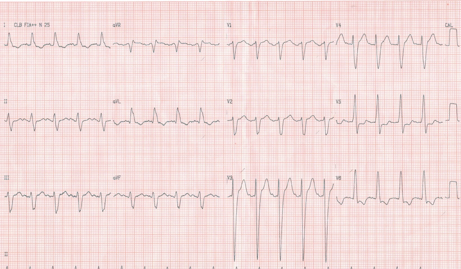 Blog de Eletrocardiografia: BRE E FUNÇÃO VENTRICULAR: ESCORE ...