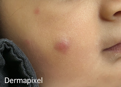 Dermapixel: septiembre 2018