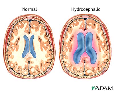 Medical ppt slides: Hydrocephalus