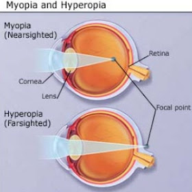 Eyedolatry: What's Happening to Our Vision? Peripheral Defocus and ...