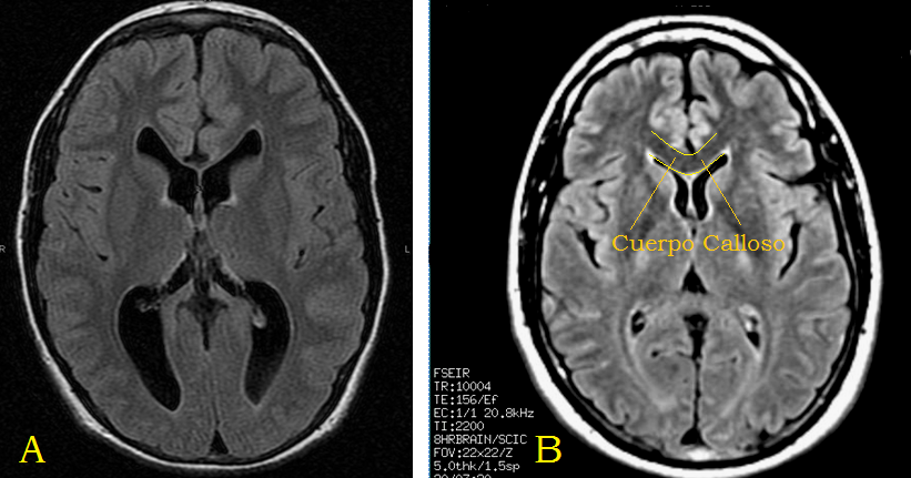 El Baúl Radiológico: DISGENESIA DEL CUERPO CALLOSO: HALLAZGOS EN TC e ...