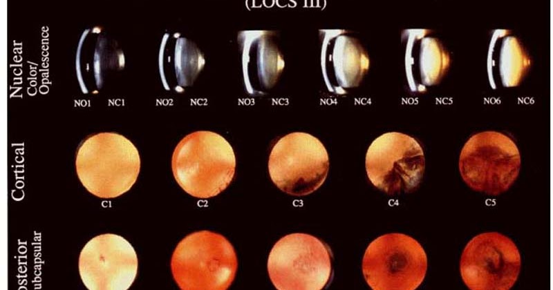 Recursos optométricos: LOCS III