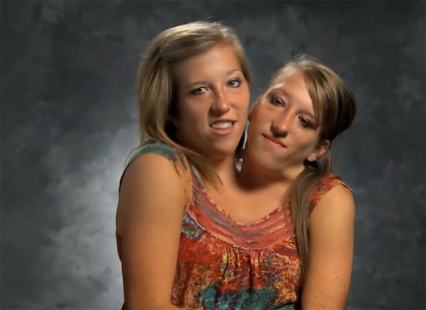 Boda De Gemelos Siameses