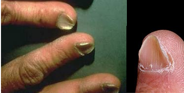 Saúde: Doenças e Deformações das unhas | Thêmes Lemos