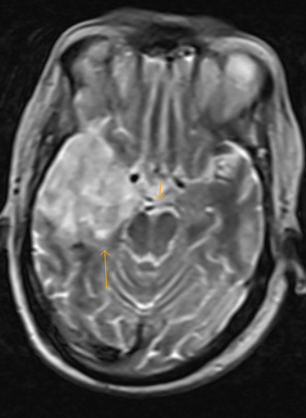Temporal Lobe Cerebritis with Midbrain Compression - Sumer's Radiology Blog