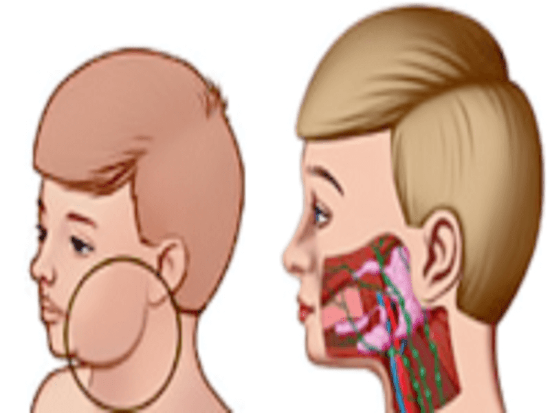 Penyebab Gondongan Dan Cara Mengobati Gondong - Klinikabar