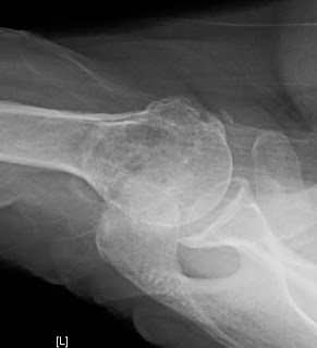 UW Shoulder and Elbow Academy: CTA arthroplasty rather than a reverse ...