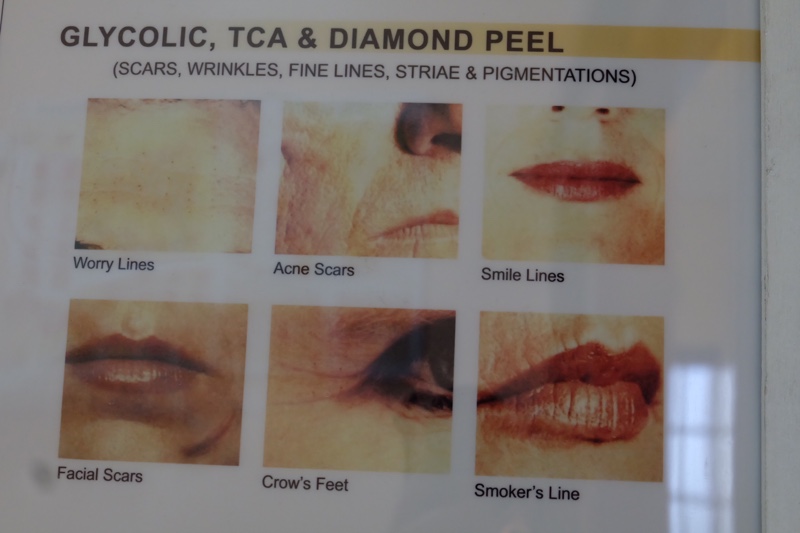 Fight Breakouts with Intense Diamond Peel - Rochelle Rivera