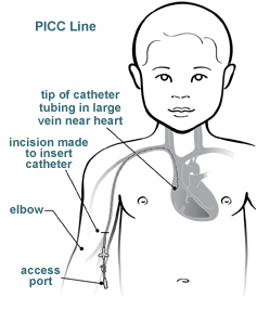 Share The Pants: Picc Line and Biopsy