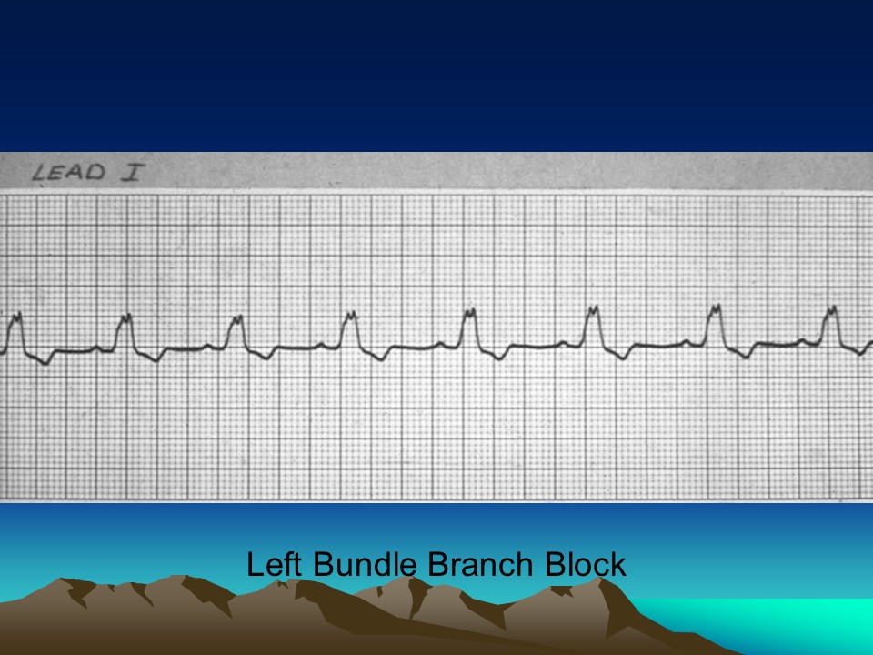 CVT Mohd Farid: Electrocardiogram ECG Part III Basic ECG Rhythm Pattern ...