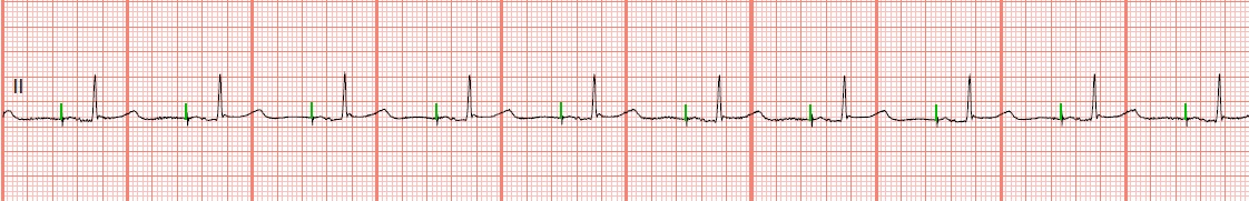 EKG Rhythm Strip Quiz 56: Paced Rhythms