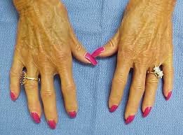 Medical Treatment Pictures-for Better Understanding: CREST Syndrome