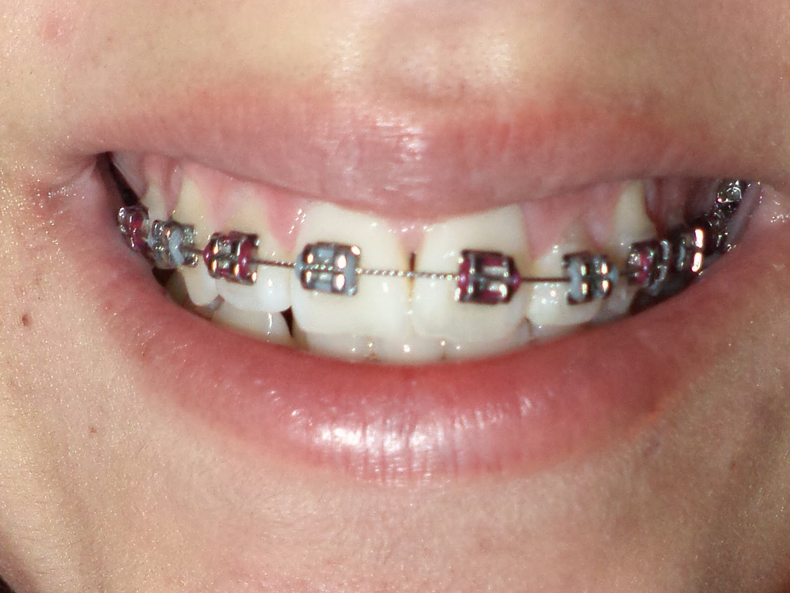 Mis Brackets: Paso a Paso [Mi experiencia]: 27-05-2014 - Cambio de Ligas