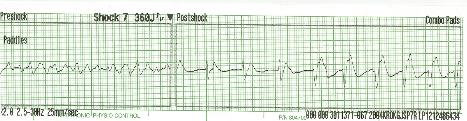 Code Blue: Refractory Ventricular Fibrillation