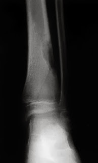 Figura 1. Fractura patológica metafisaria distal de tibia sobre Fibrona ...