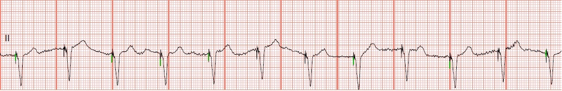 EKG Rhythm Strip Quiz 40