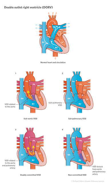 Hello and welcome to my blogspot!: 23. Specific Lesions: Double outlet ...