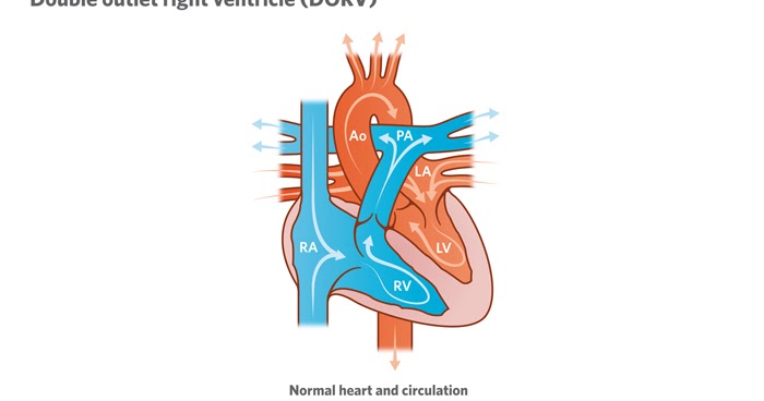 Hello and welcome to my blogspot!: 23. Specific Lesions: Double outlet ...