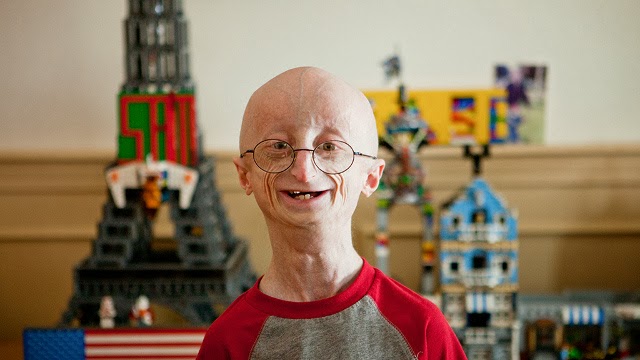 Progeria : Le syndrome du vieillissement accéléré ~ La génétique