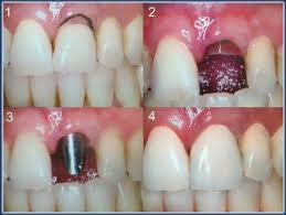 Dental Sparkling: Postes intrarradiculares