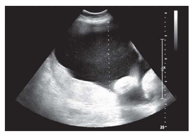 hEiDiMatEs - MeDICinE: Quintero staging system - twin to twin ...