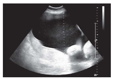 hEiDiMatEs - MeDICinE: Quintero staging system - twin to twin ...