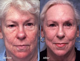 Non-Invasive And Natural Facelifts Using Face Aerobics Exercises