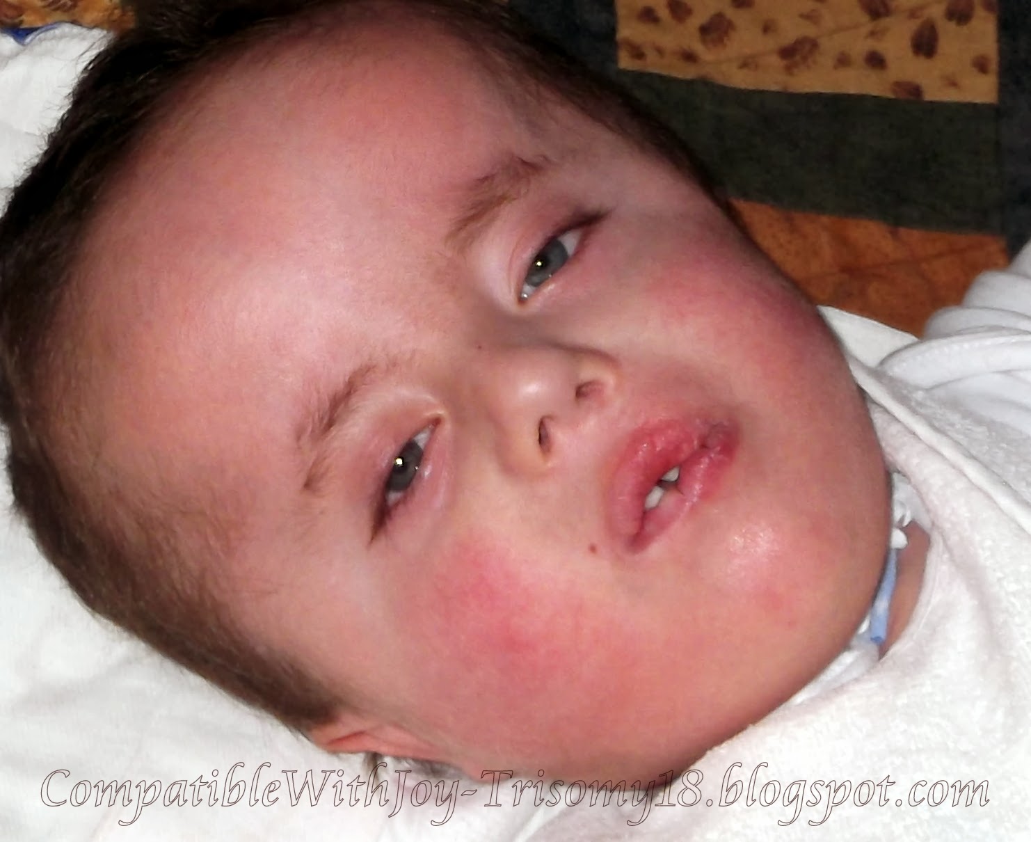 Compatible With Joy-Trisomy18: 02/01/2014 - 03/01/2014