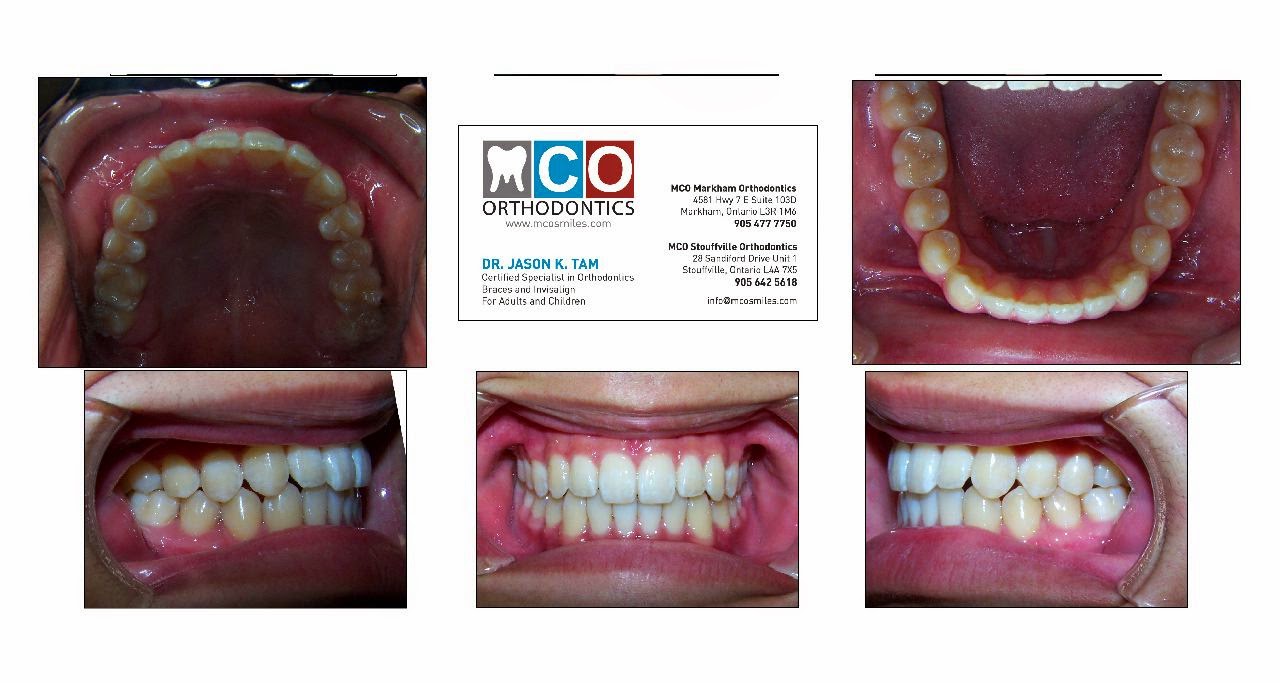 Your Markham Orthodontist, Toronto Invisalign, and Richmond Hill Braces ...