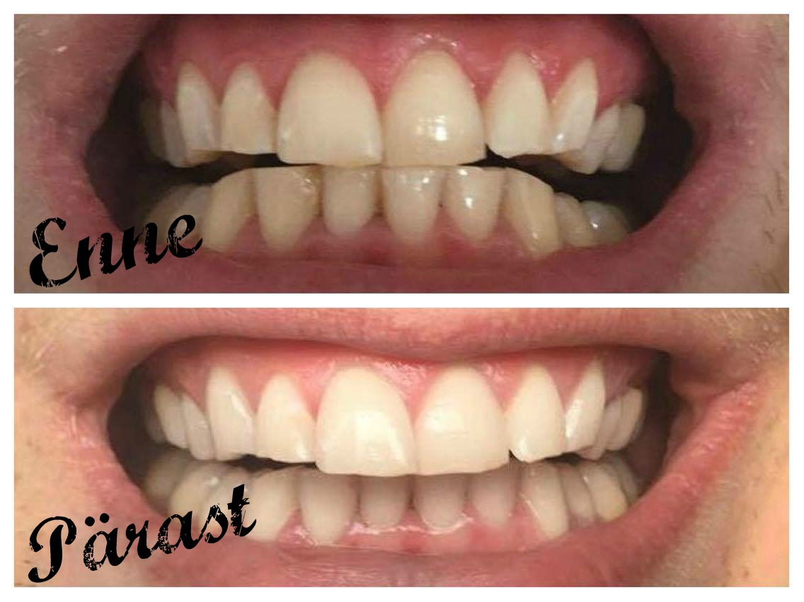 Life of Liisa: Naeratus särama Brilliant Smile'iga!