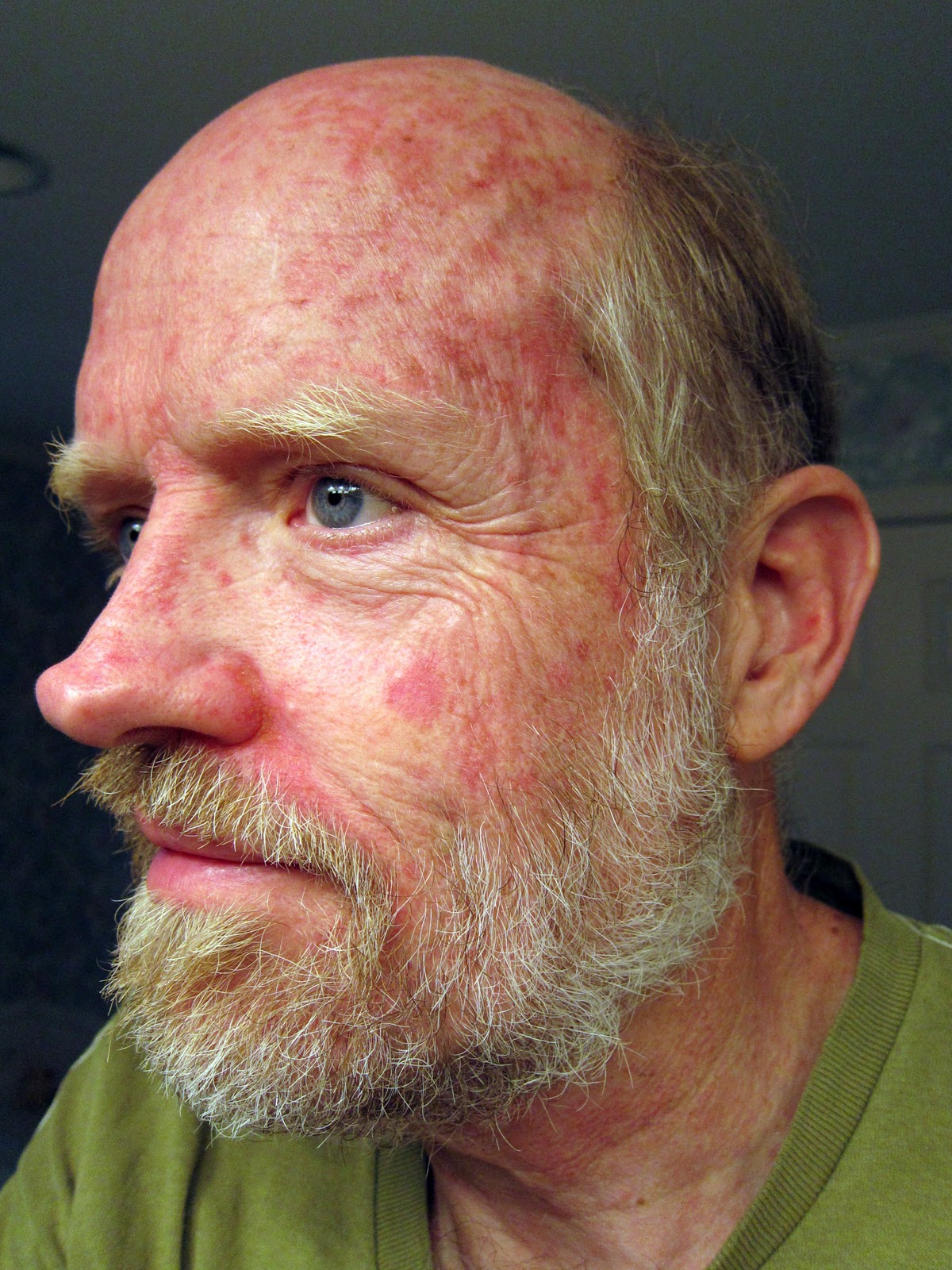 Efudex - Round Two: Day 11