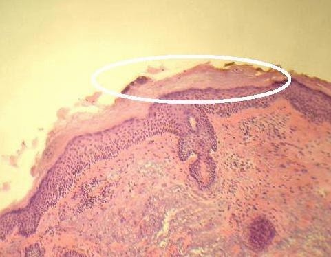 We Know Mohs: Slide Review: Thick skin and sun damaged skin