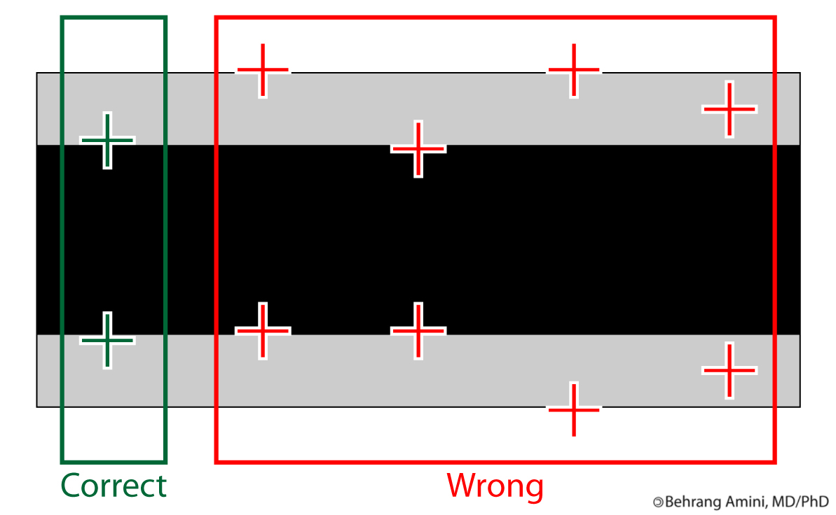 Roentgen Ray Reader: Nuchal Translucency